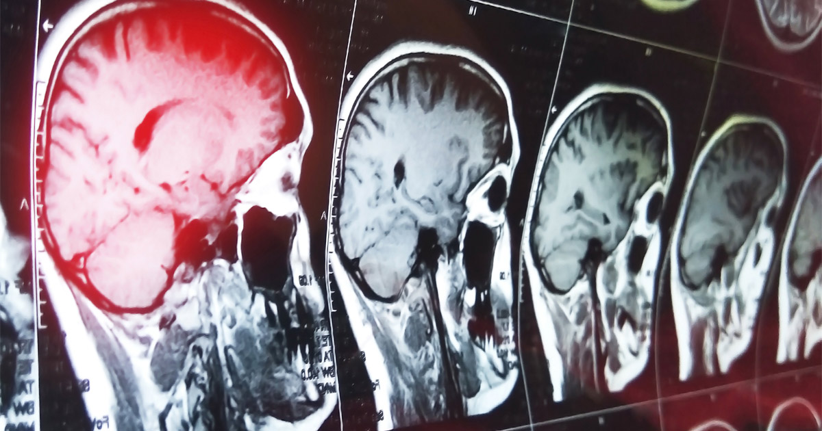 Are Traumatic Brain Injuries Common in Slip and Fall Accidents?